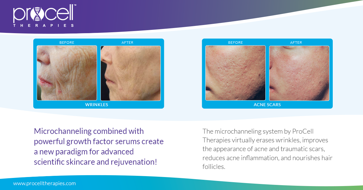 Dallas ProCell Microchanneling - North Dallas Permanent Cosmetics