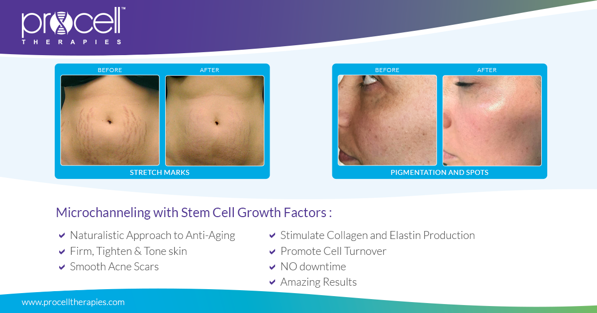 Dallas ProCell Microchanneling - North Dallas Permanent Cosmetics