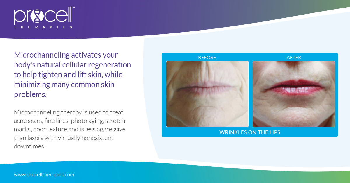 Dallas ProCell Microchanneling - North Dallas Permanent Cosmetics
